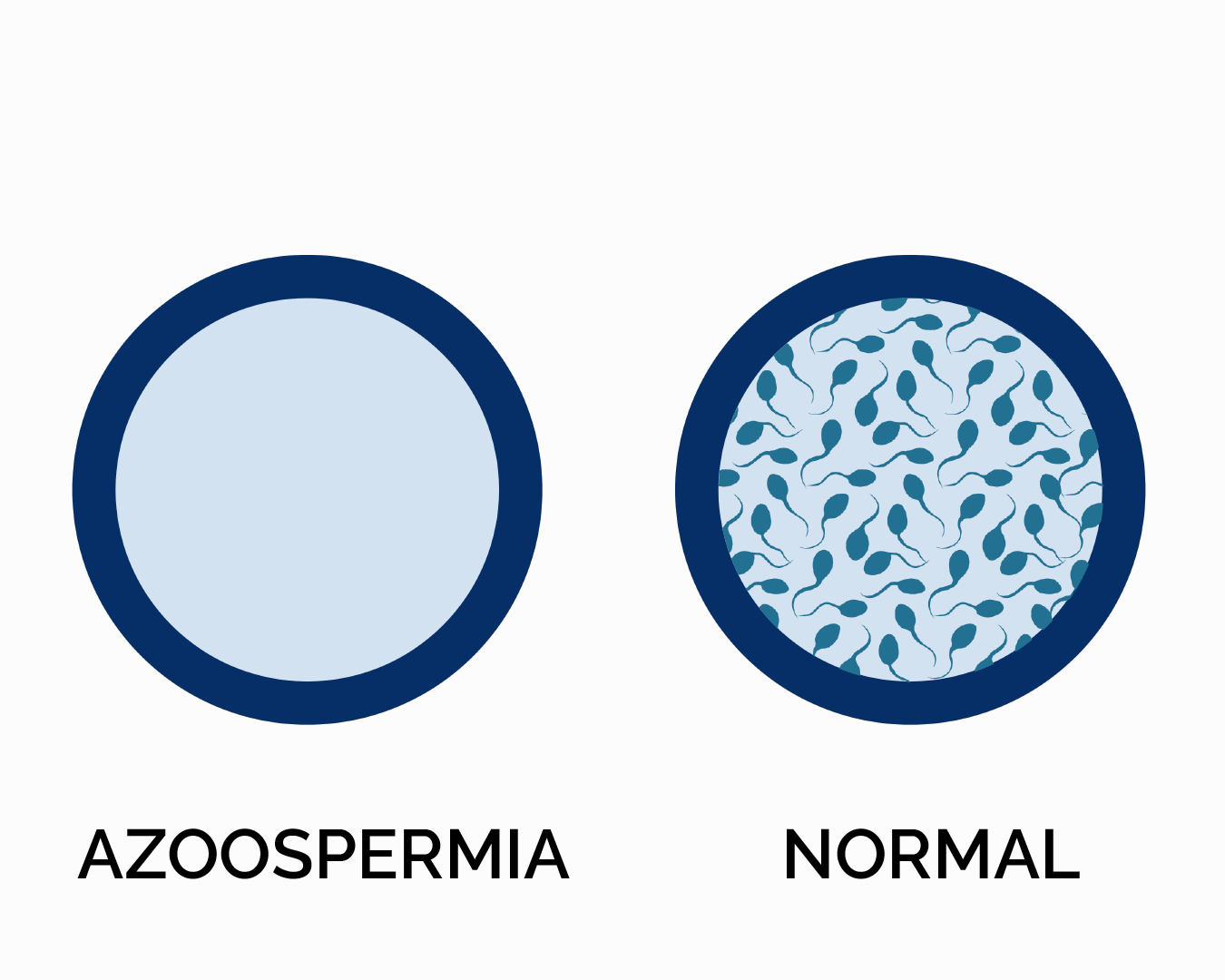 Azoospermia - Fertility Clinic